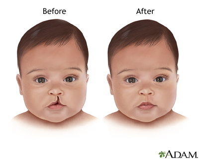 Cleft Lip and Palate – Wake Forest Baptist Health | Atrium Health Wake ...