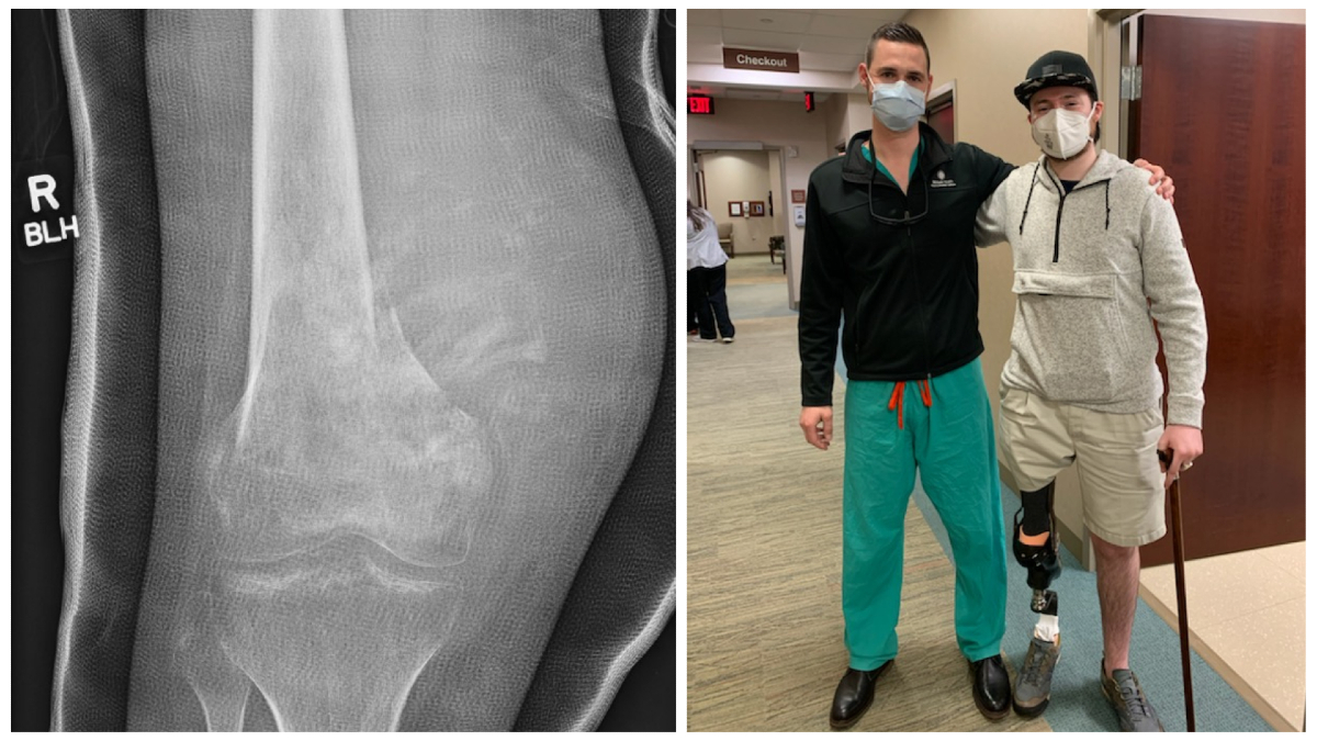 Daily Dose - A Rare Limb Salvage Surgery Puts Cancer Patient Back in ...