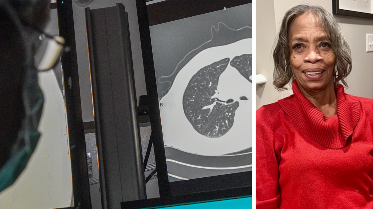 Daily Dose - Incidental Lung Nodule Program Success: Early Detection ...